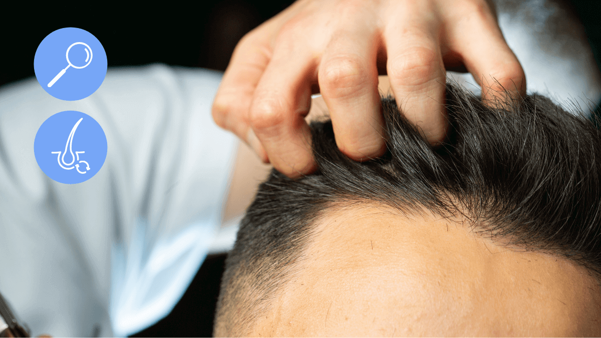 6 Accurate Signs of Balding - how to tell if you’re going bald