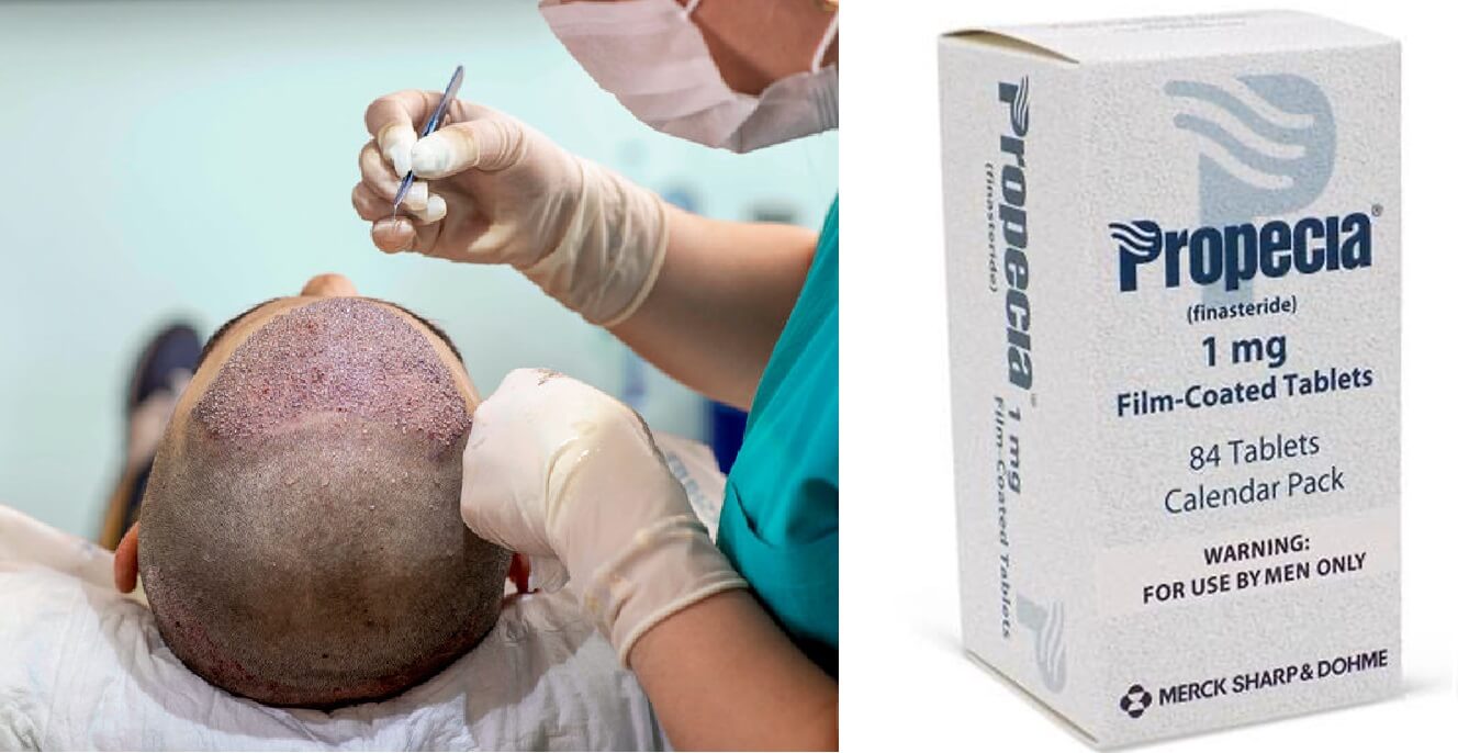 Hair Transplant vs. Finasteride - which should you choose? - UnitedCare
